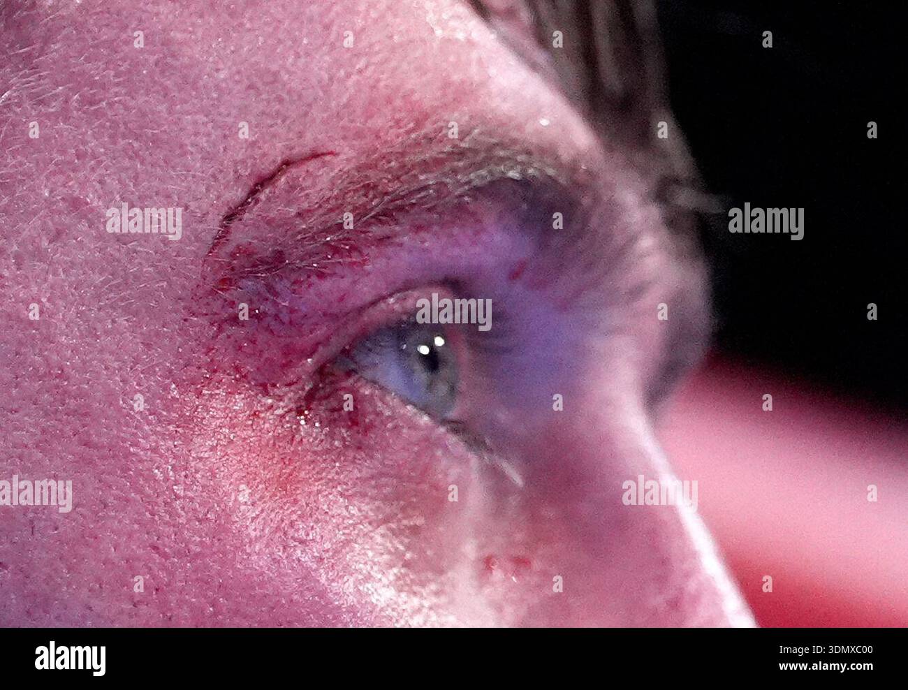 A cut on the brow of Jack England in the super feather weight bout at ...
