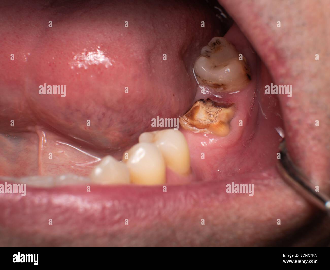 Lower mandibular second molar extensively decayed to near gum level ...