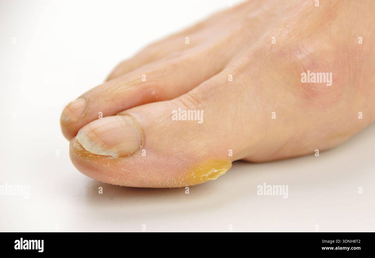 Callus and hyperkeratosis on toe of a female isolated over white ...