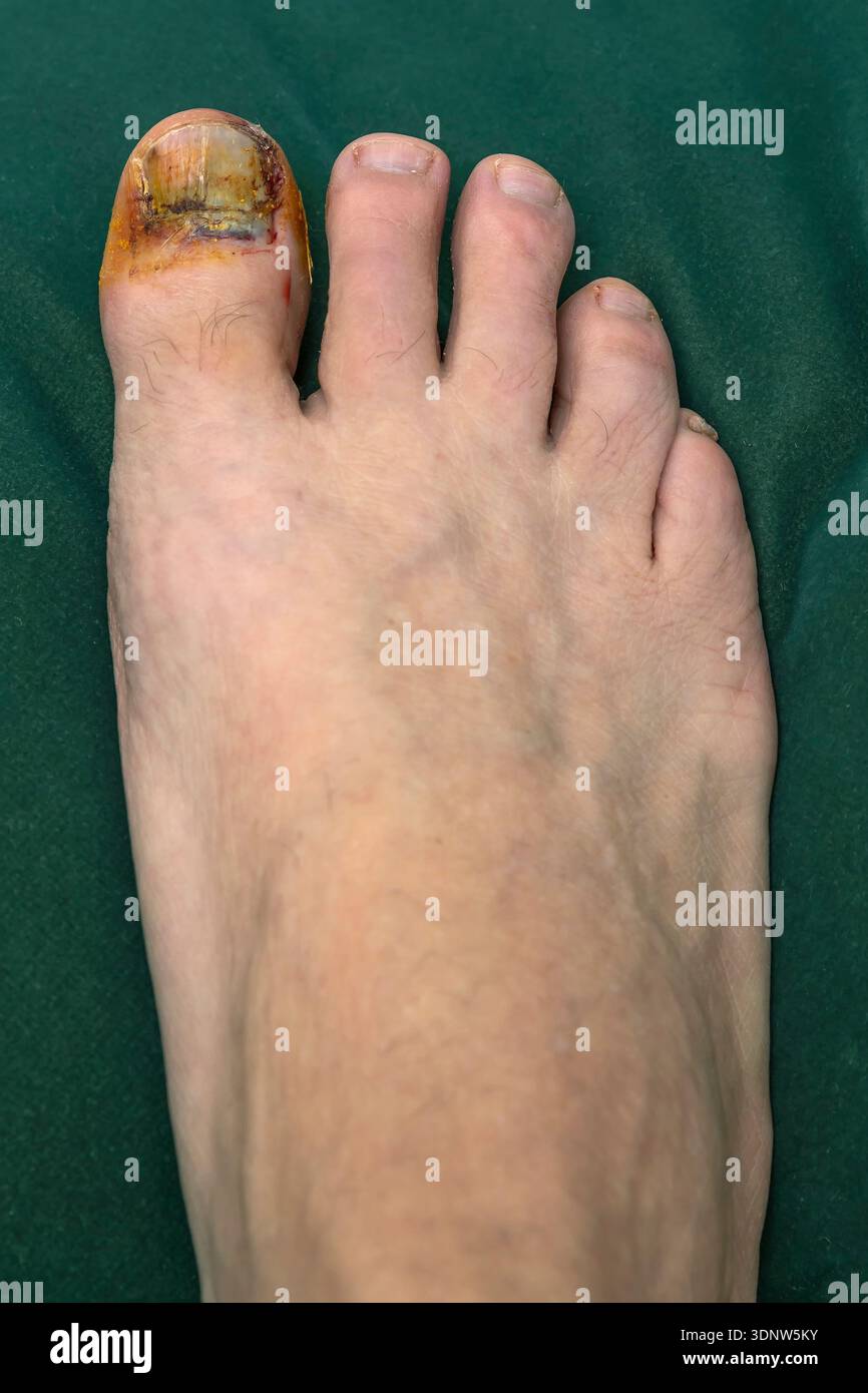 Clubbed foot hi-res stock photography and images - Alamy