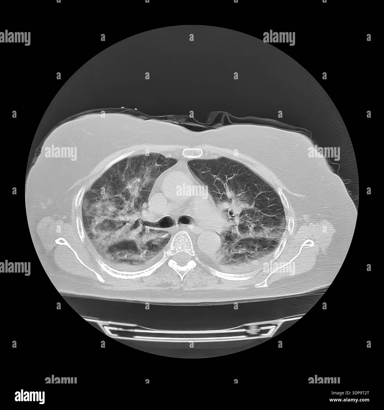 Computed tomography (CT) scan of an axial section of human lungs ...