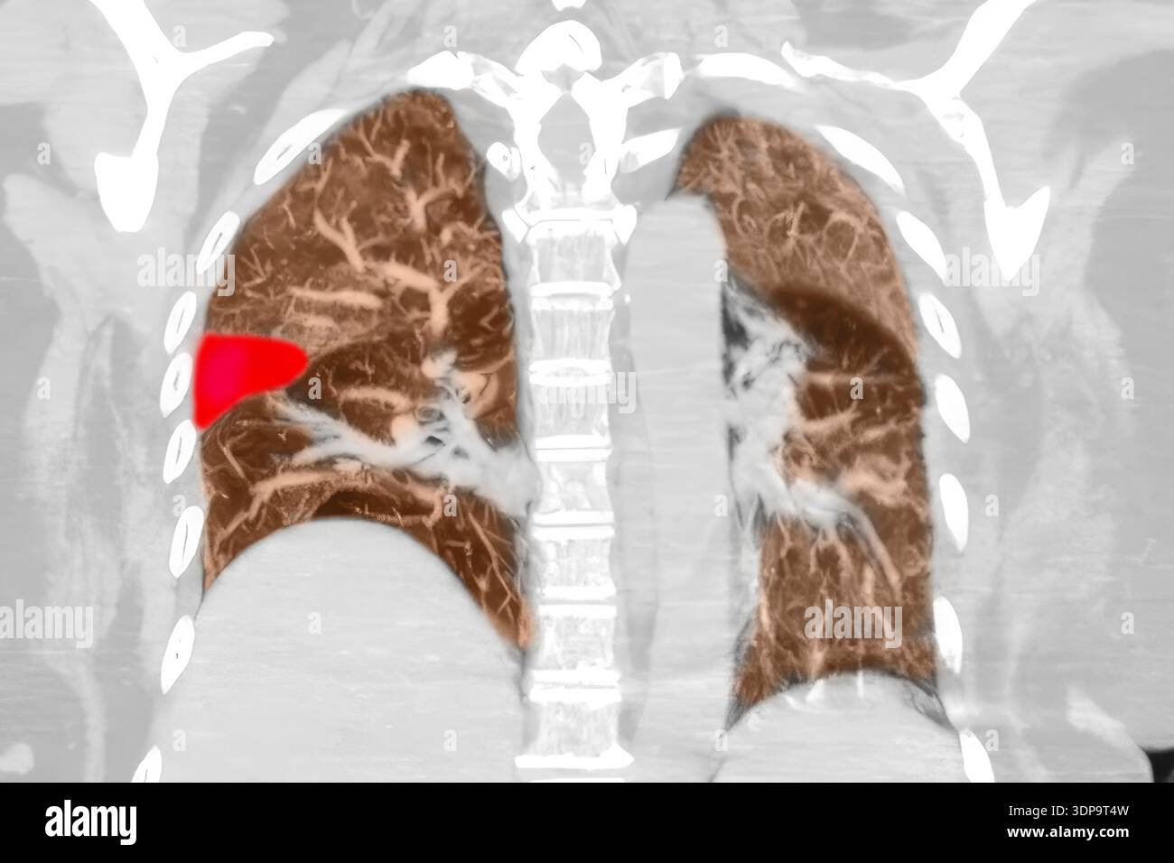 Colour-enhanced CT scan showing wedge-shaped pulmonary infarction in ...
