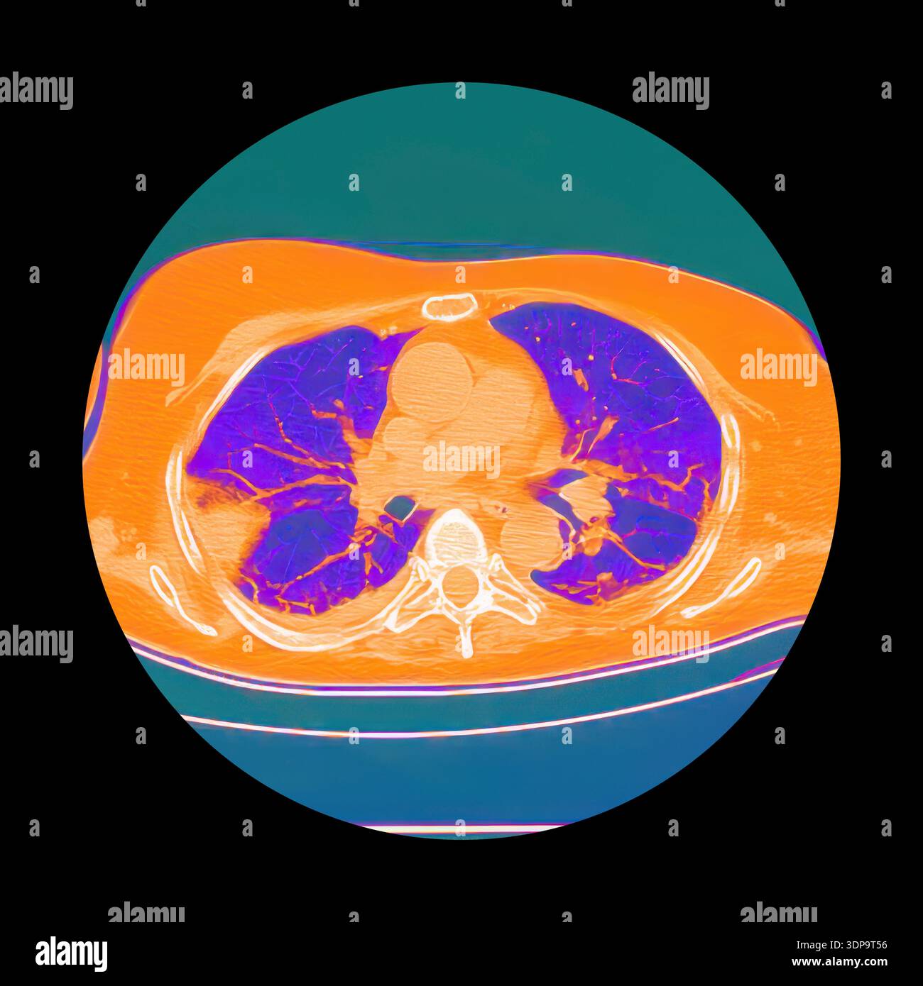 Colour-enhanced CT scan showing wedge-shaped pulmonary infarction in ...