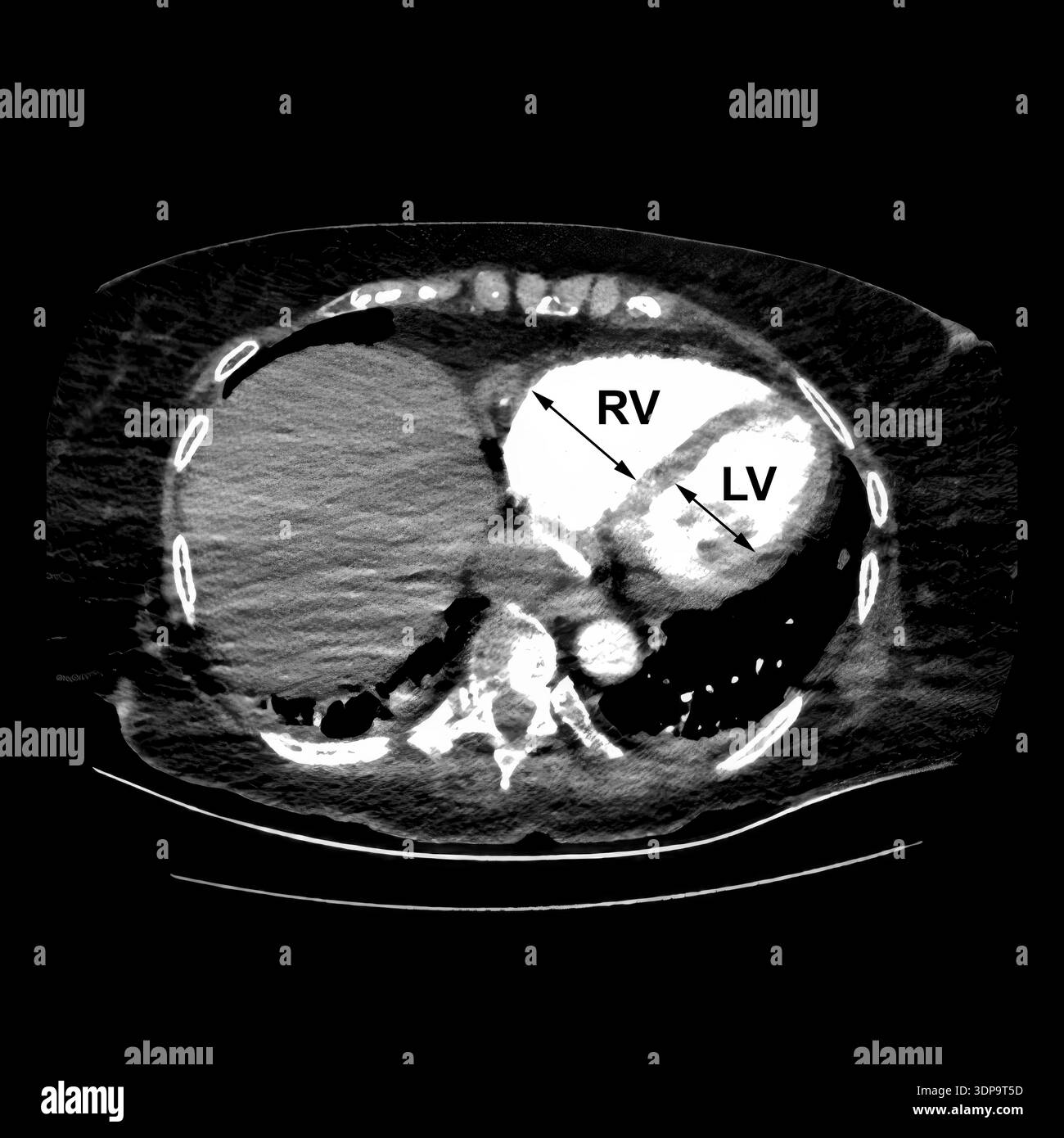 CT scan showing right ventricular strain in a patient with pulmonary ...