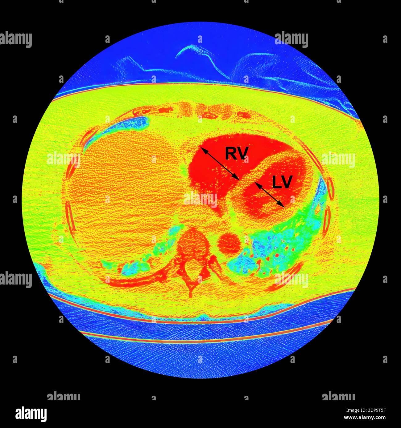 Colour-enhanced CT scan showing right ventricular strain in a patient ...