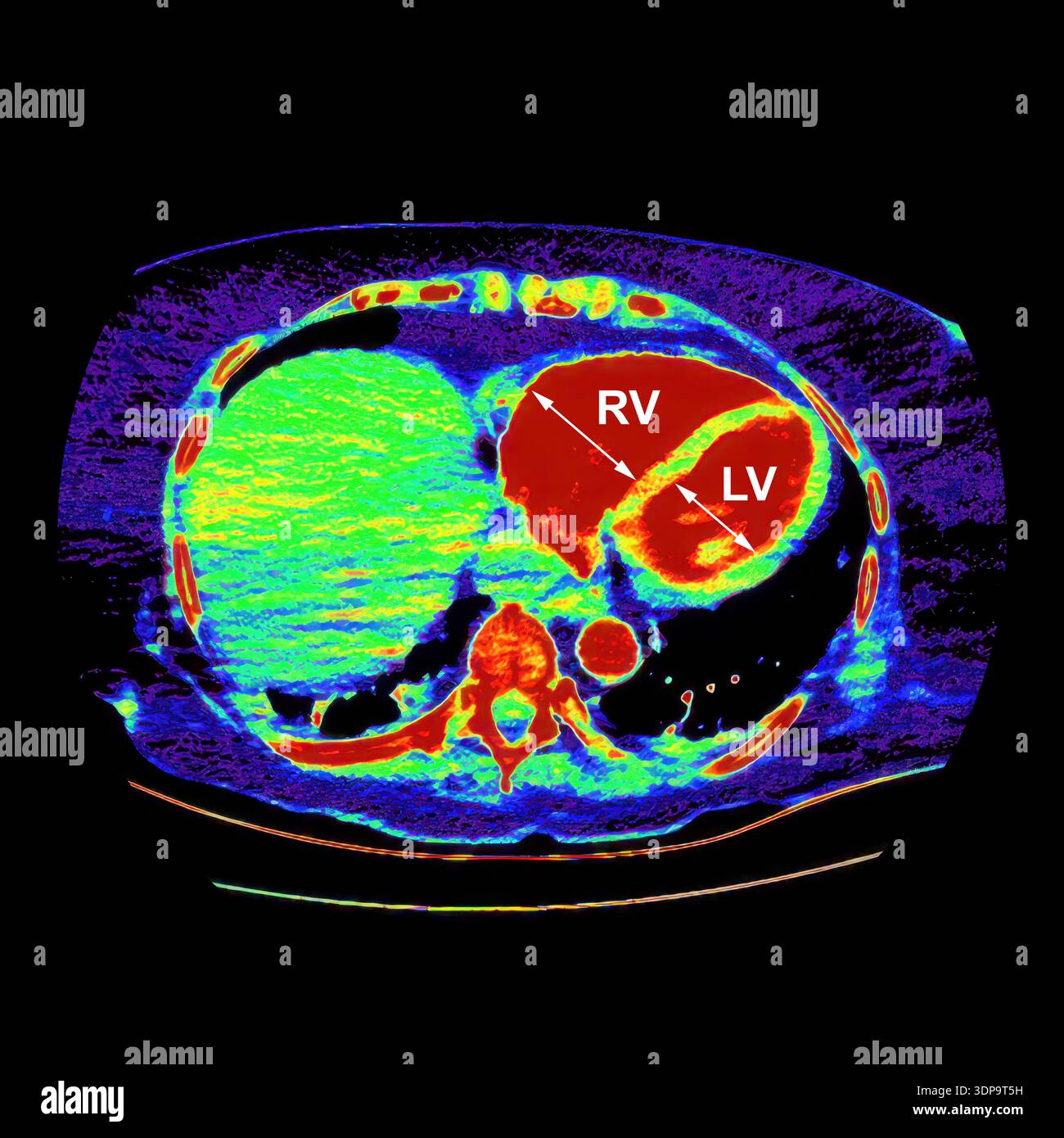 Colour-enhanced CT scan showing right ventricular strain in a patient ...