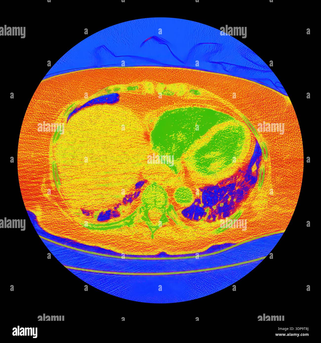 Colour-enhanced CT scan showing right ventricular strain in a patient ...