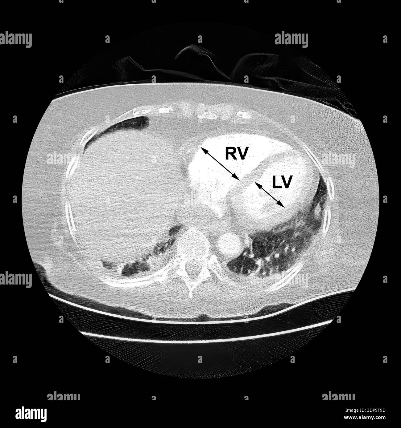 Ventricular septum right ventricle Black and White Stock Photos ...