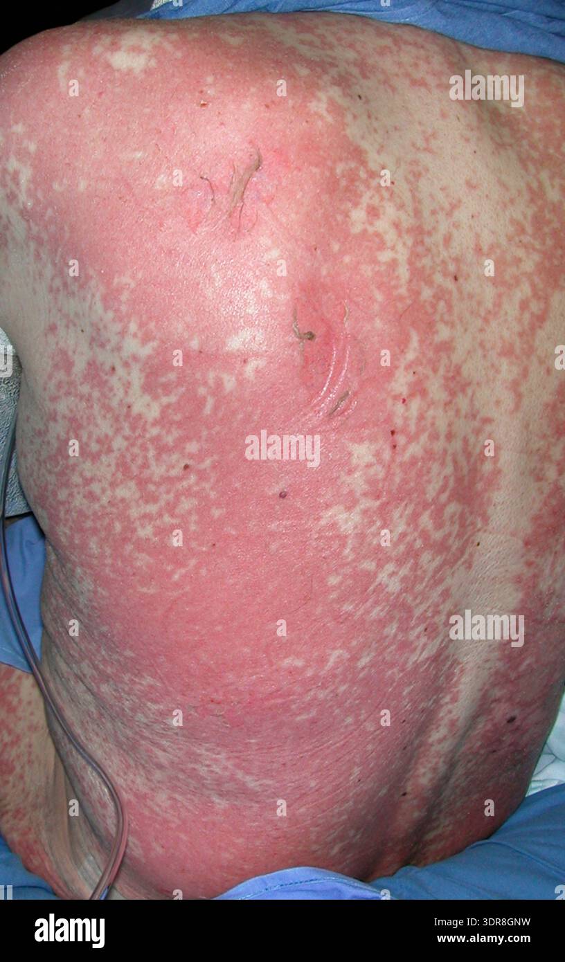 Toxic epidermal necrolysis. Erythema and epidermal detachment on the ...