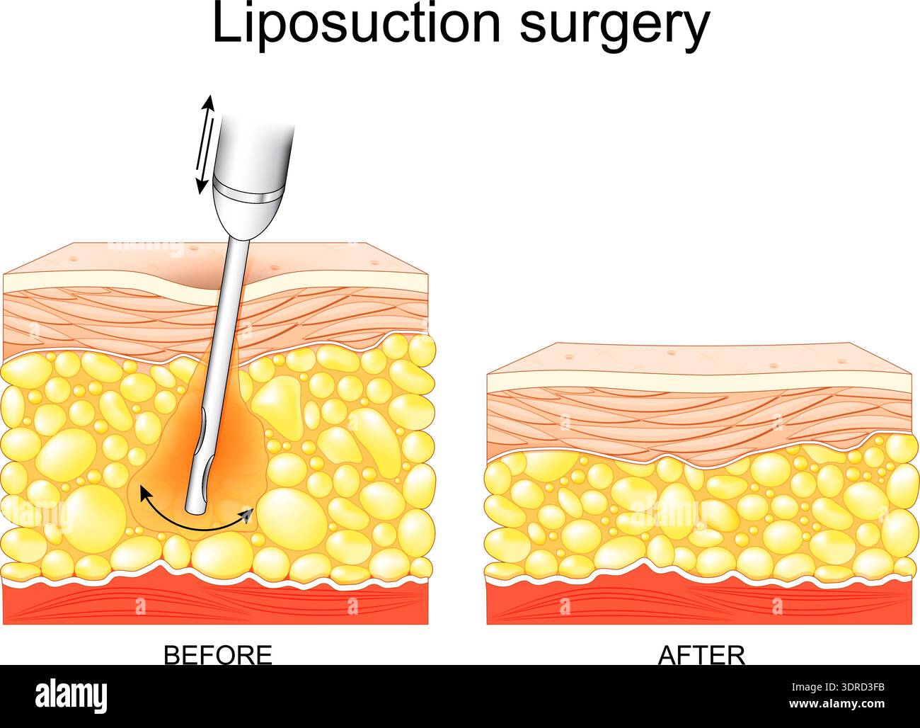 Liposuction surgery lipo before hi-res stock photography and images - Alamy