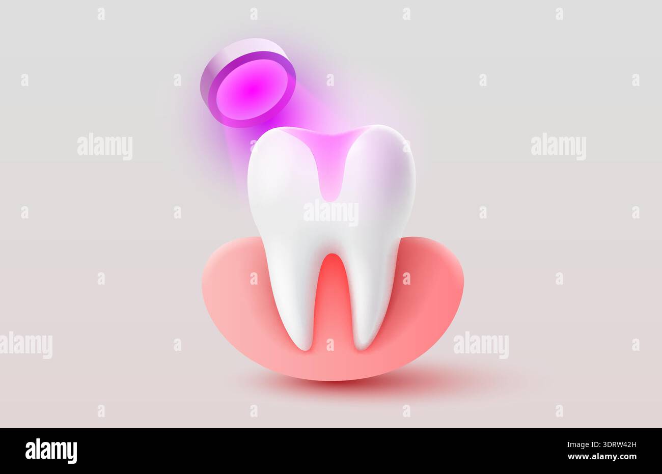 Dental tooth filling procedure with light curing. A modern concept of ...