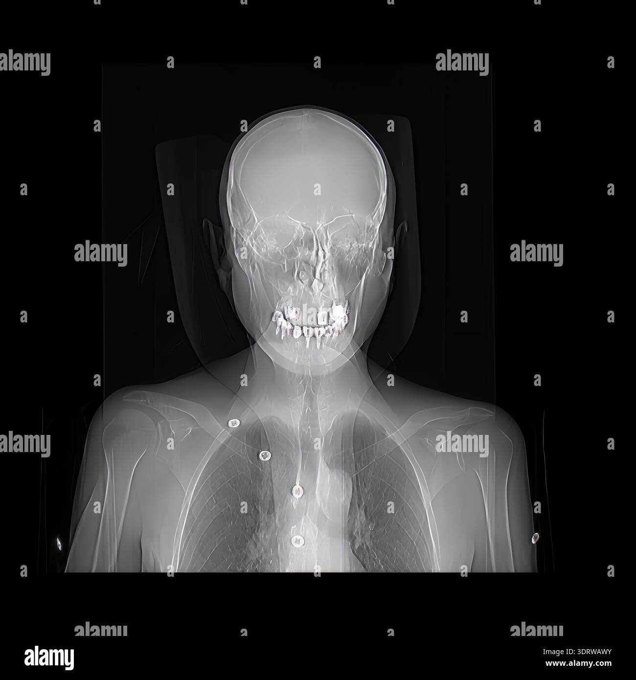 front view of a Patient undergoing CT scan showing detailed skeletal ...
