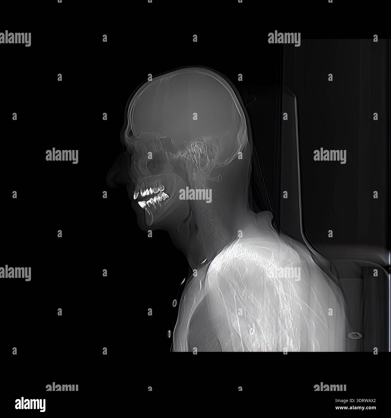 Side view of a Human head, neck, and upper chest CT scan showing the ...