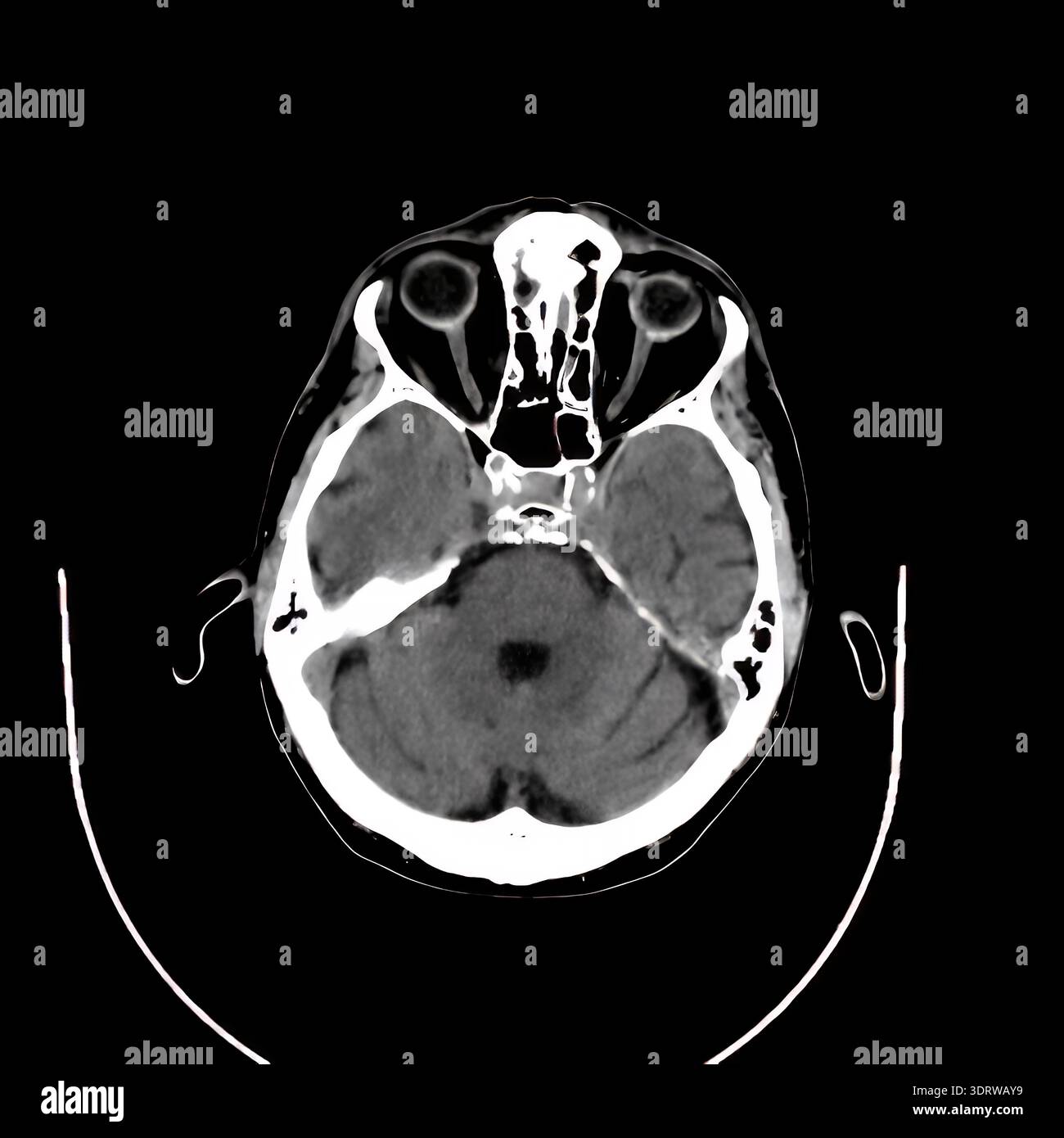 Human head CT scan presenting cranial anatomy including brain tissue ...