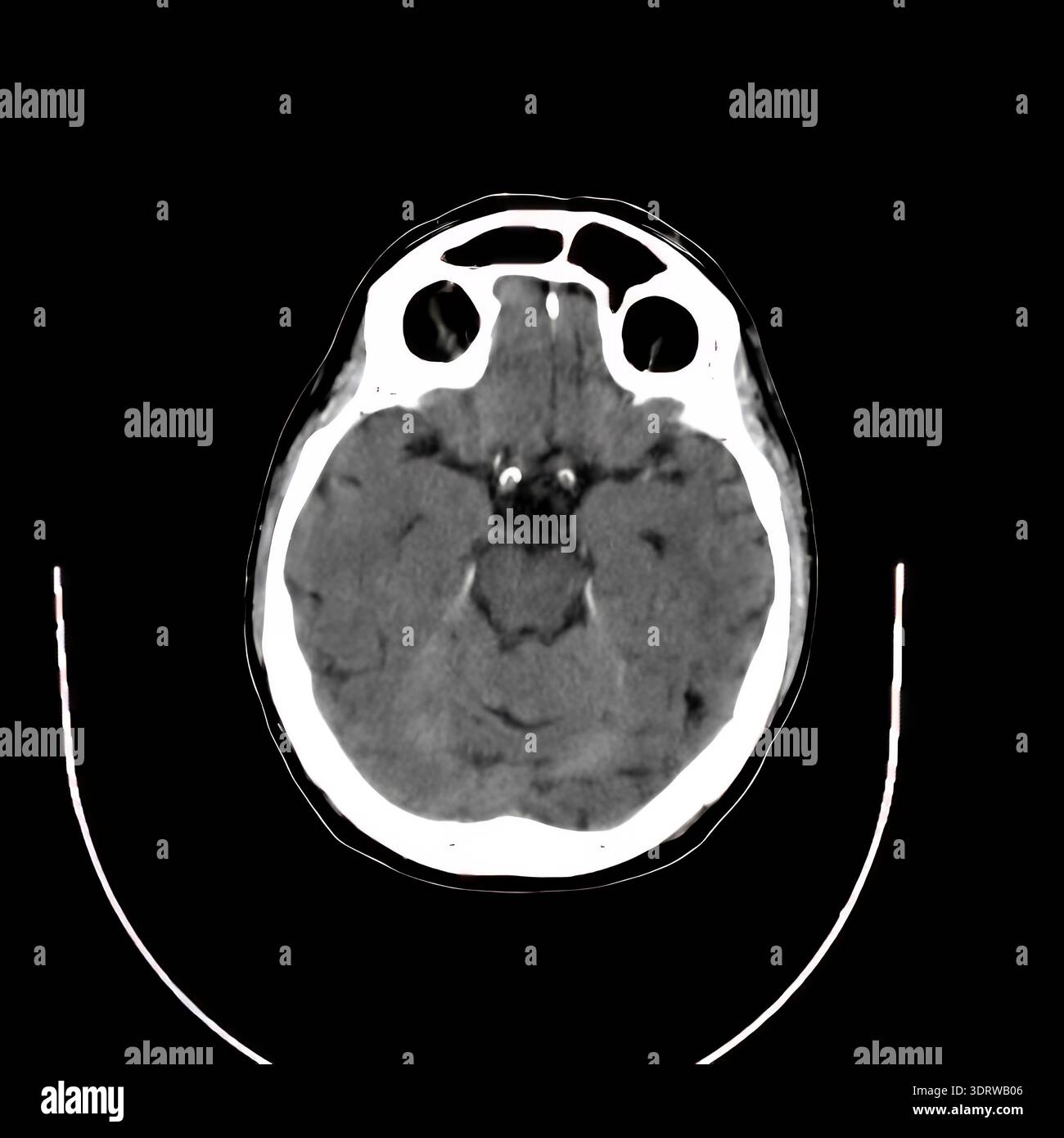 Human head CT scan presenting cranial anatomy including brain tissue ...