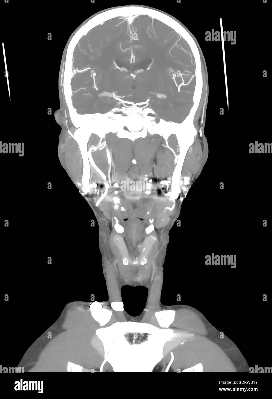 Cervical spine arteries veins system hi-res stock photography and ...