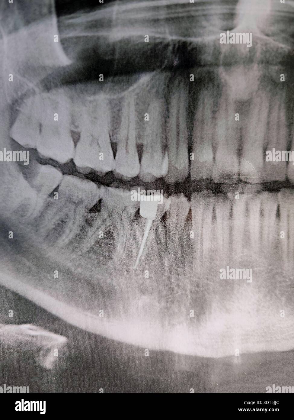 Panoramic dental x-ray image showing human teeth and jaw. Medical ...