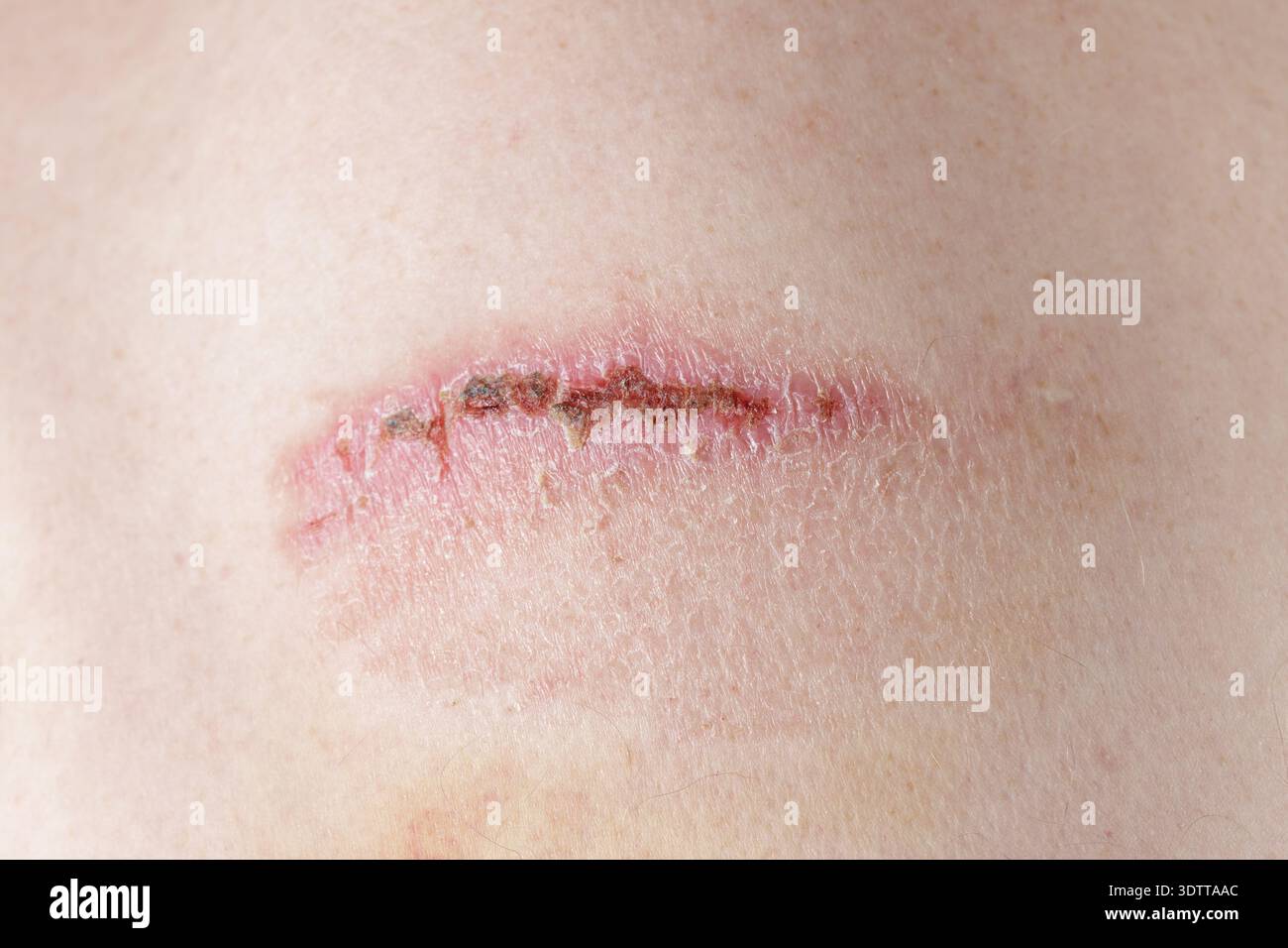 Skin abrasion hi-res stock photography and images - Alamy