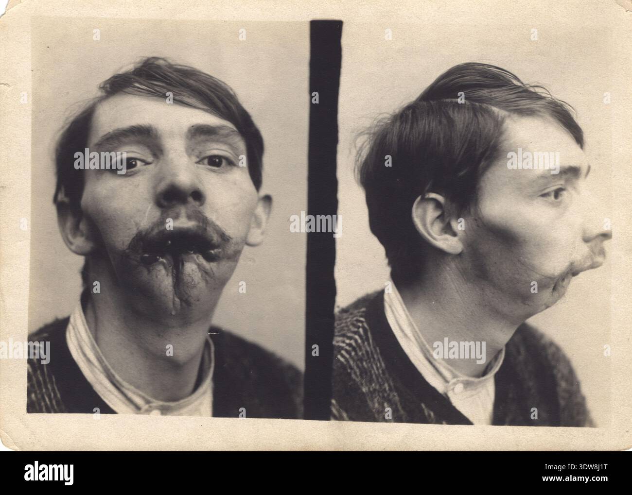 Facial wound on a world war i soldier. hi-res stock photography and ...