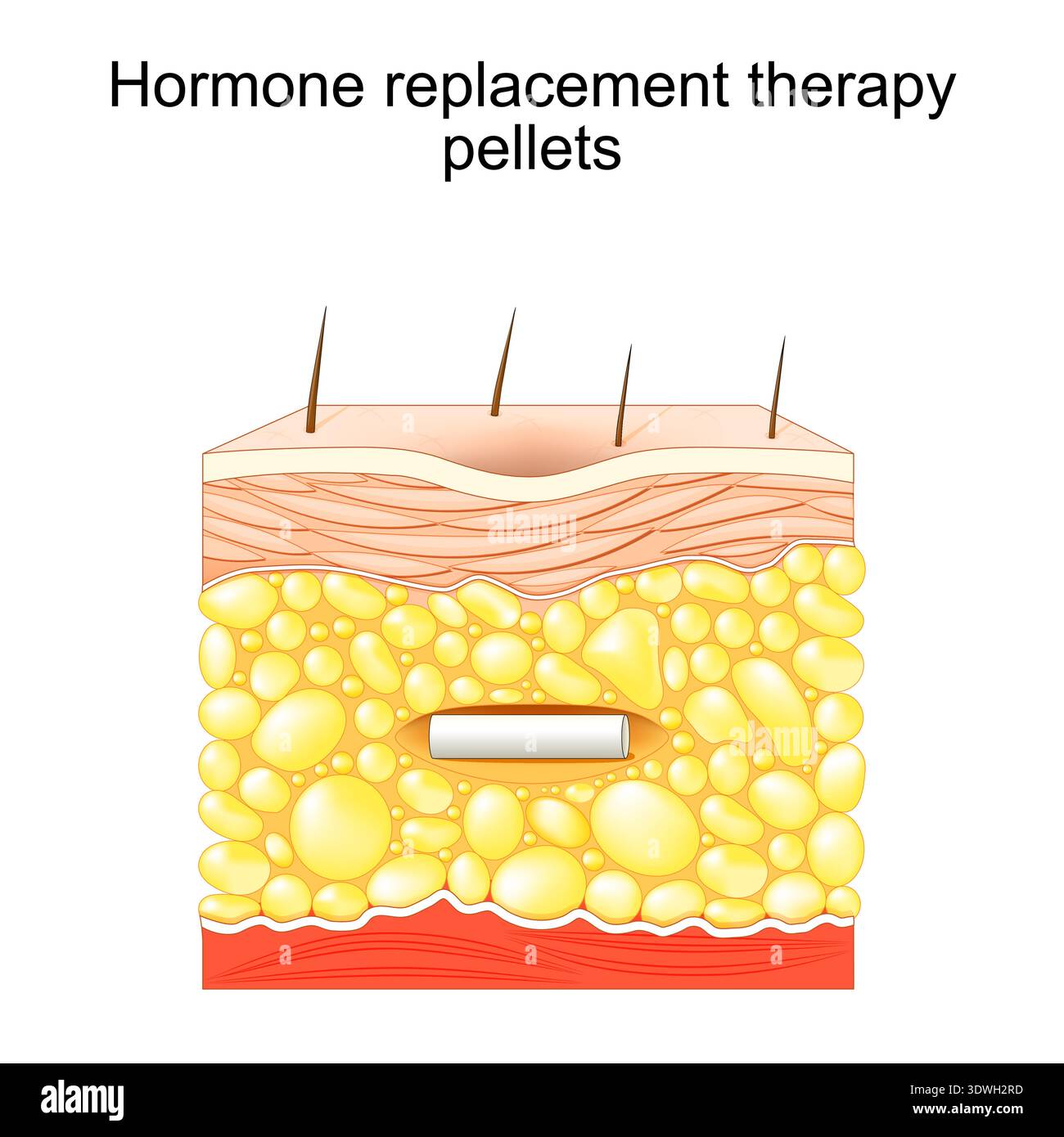 Hormone replacement therapy pellets. Cross section of a human skin with ...