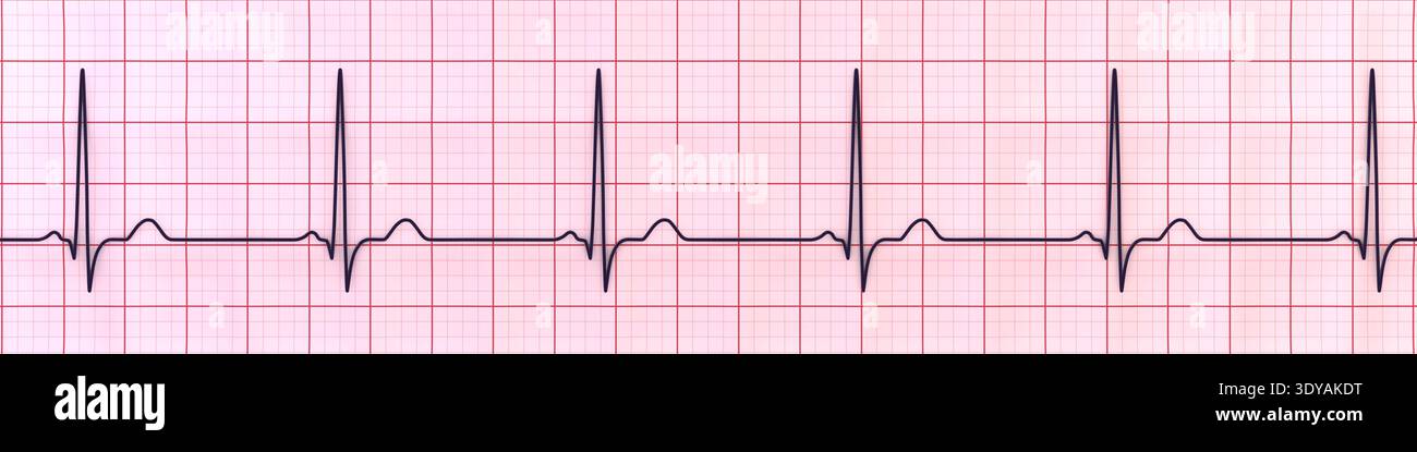 Illustration of a normal electrocardiogram (ECG), showing a standard ...