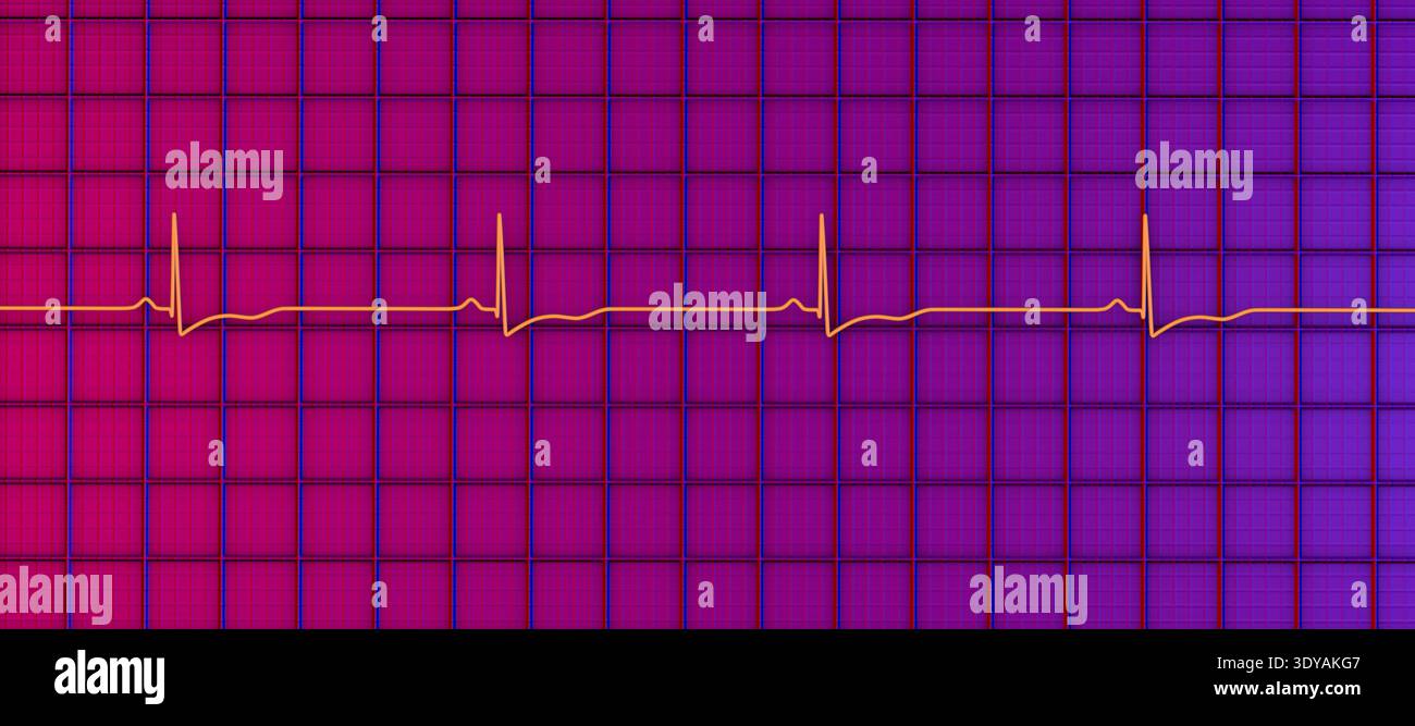 Illustration of an electrocardiogram (ECG) showing right ventricular ...