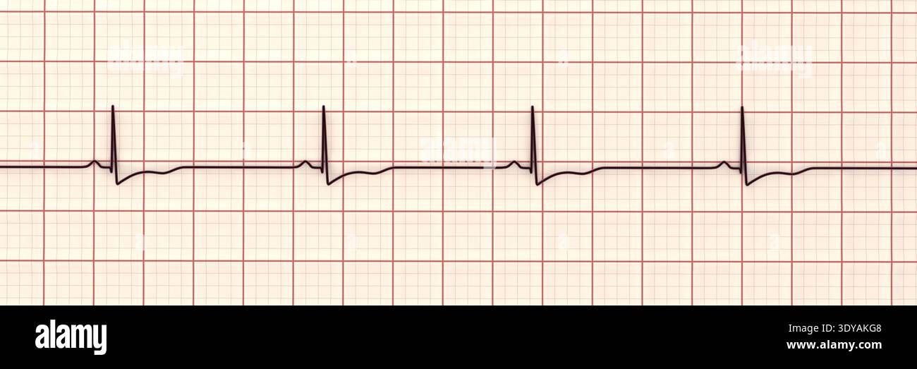Illustration of an electrocardiogram (ECG) showing right ventricular ...