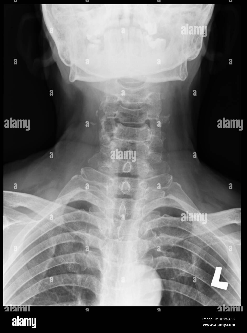 An AP (anteroposterior) view, cervical spine X-ray of a 67-year-old ...