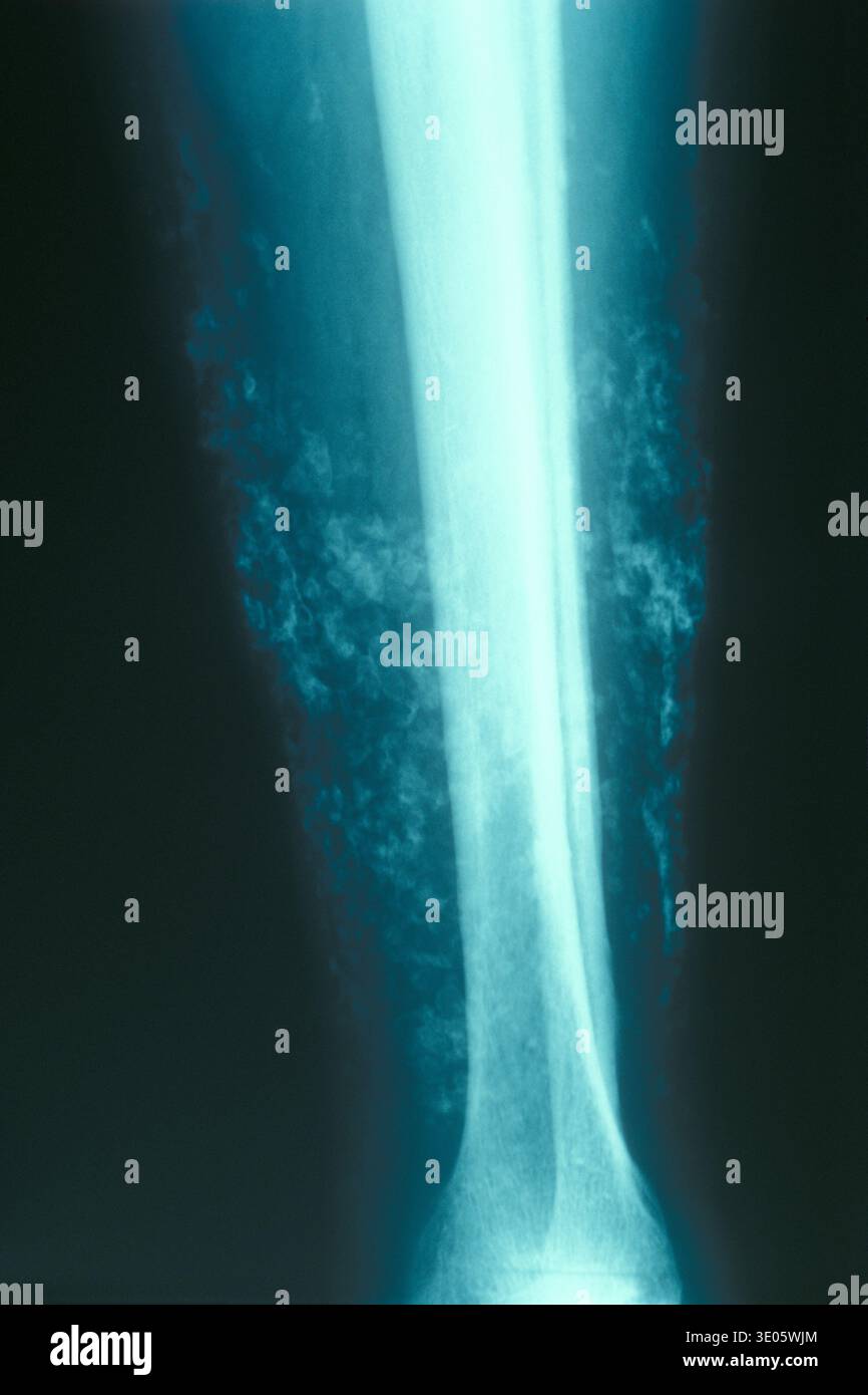X-ray of venous insufficiency in the lower limb with subcutaneous ...