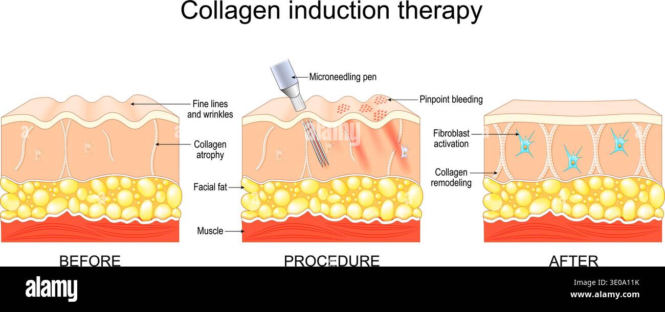 Collagen induction therapy. Before and After Microneedling procedure ...