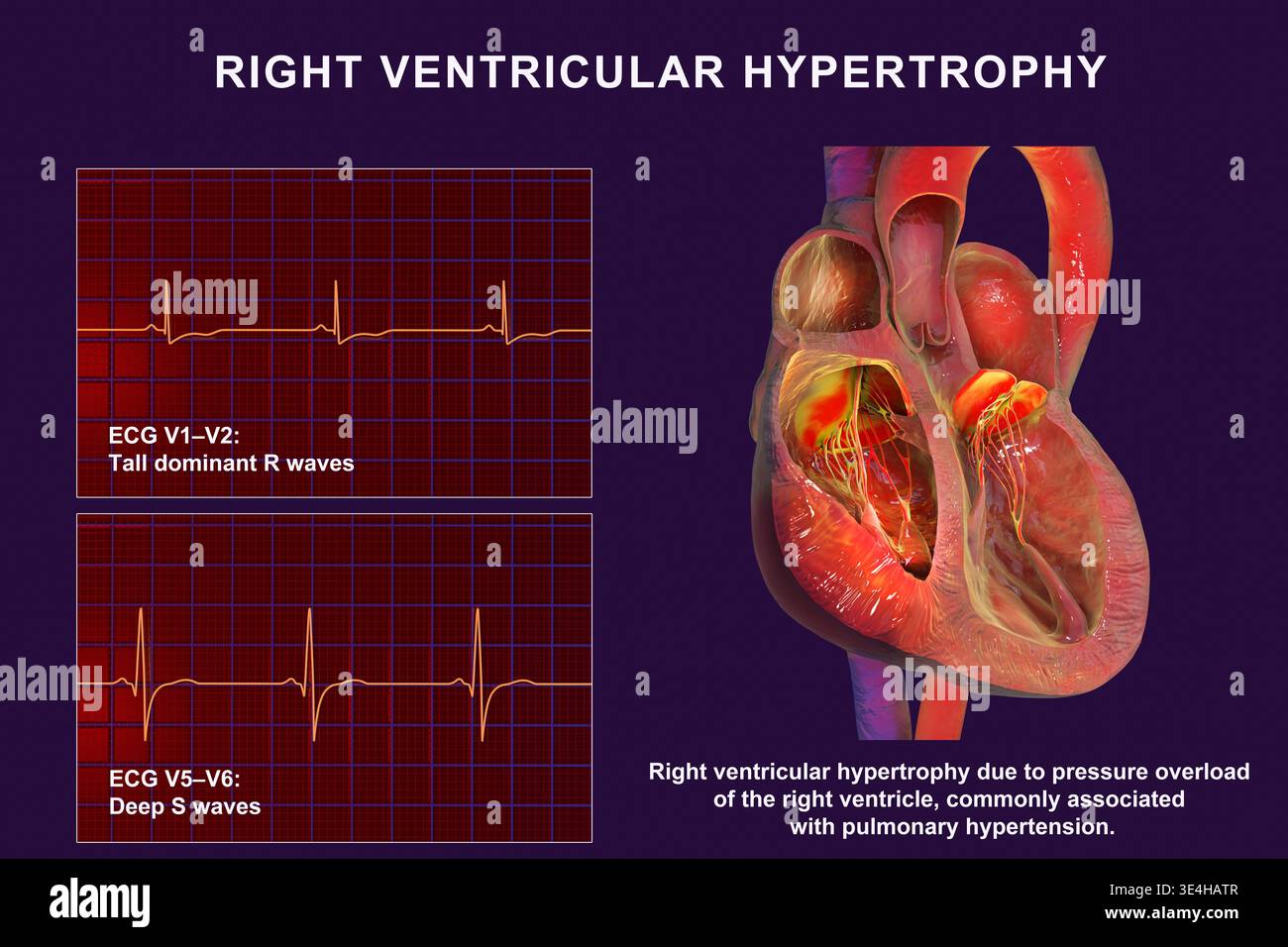 Right ventricular hypertrophy. Illustration showing thickened right ...
