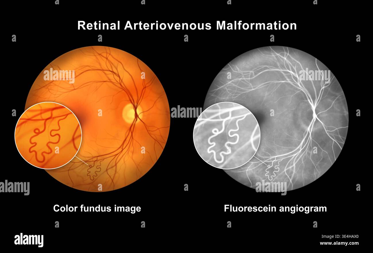 Retinal arteriovenous malformation. Illustration showing colour fundus ...