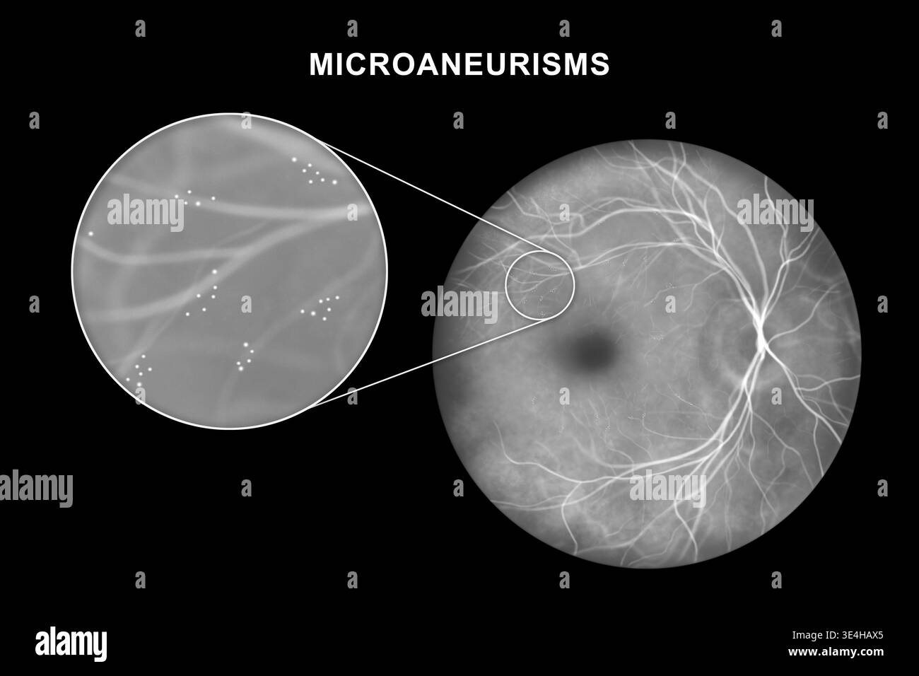 Retina with microaneurysms. Illustration in the style of a fluorescein ...