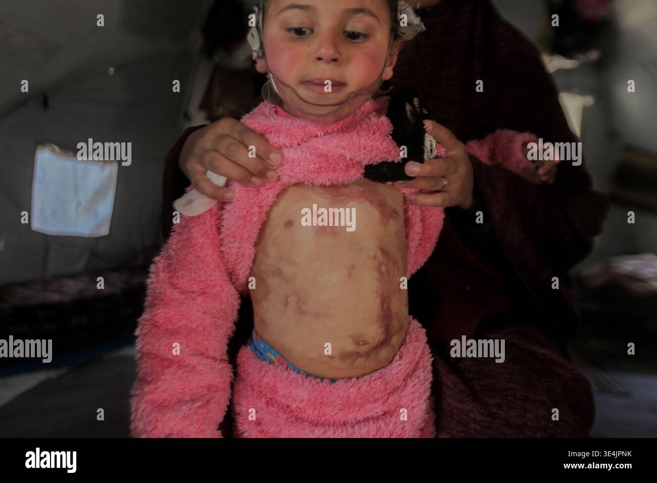 Palestine, Gaza. 28th Mar, 2026. (INT) Palestinian Child Suffers from ...