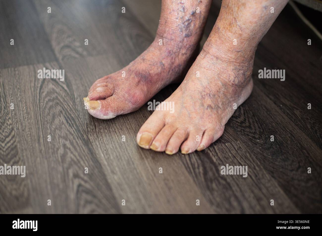 Senior person's feet with visible varicose veins and unhealthy skin ...