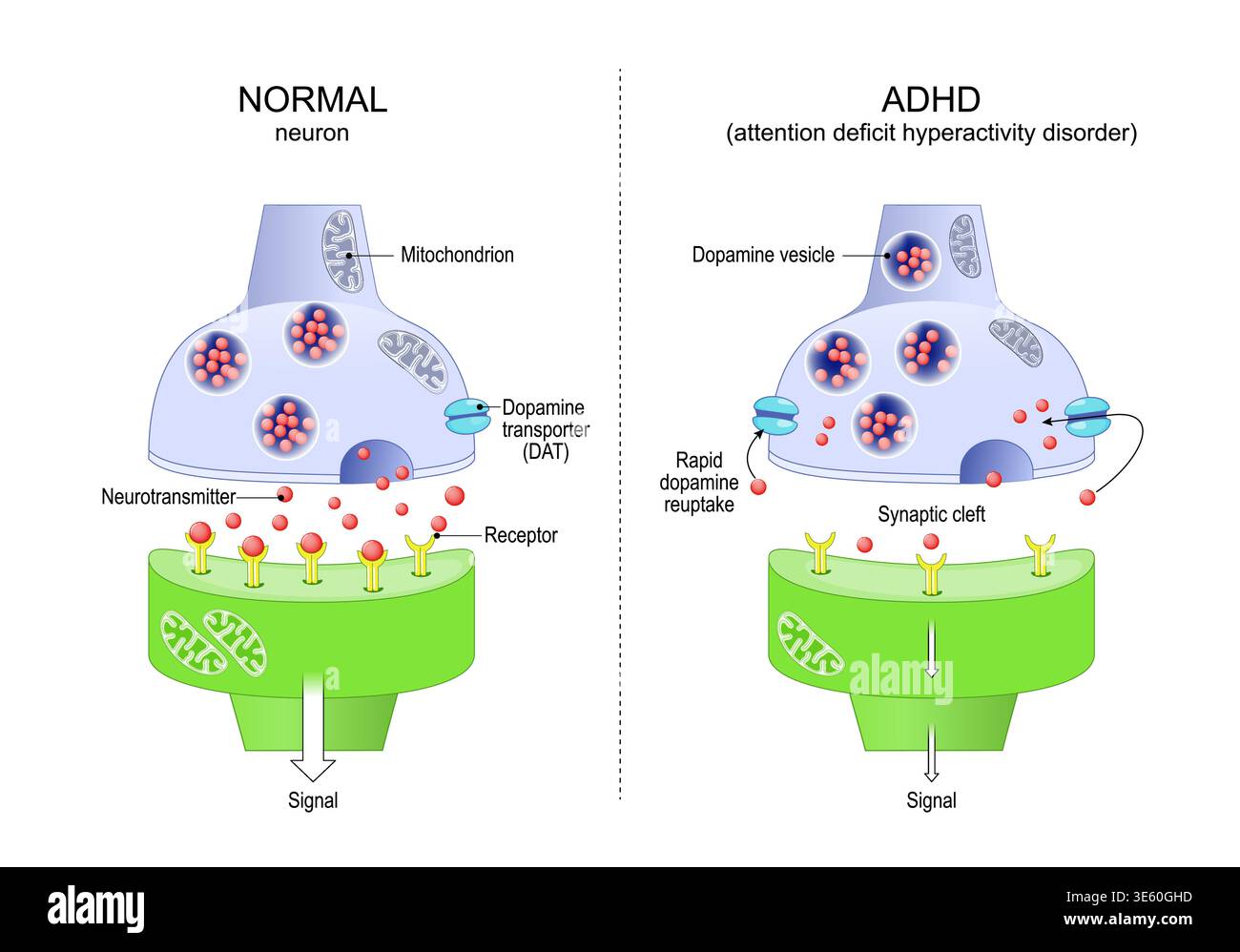 Normal neuron and ADHD neuron. Attention deficit hyperactivity disorder ...