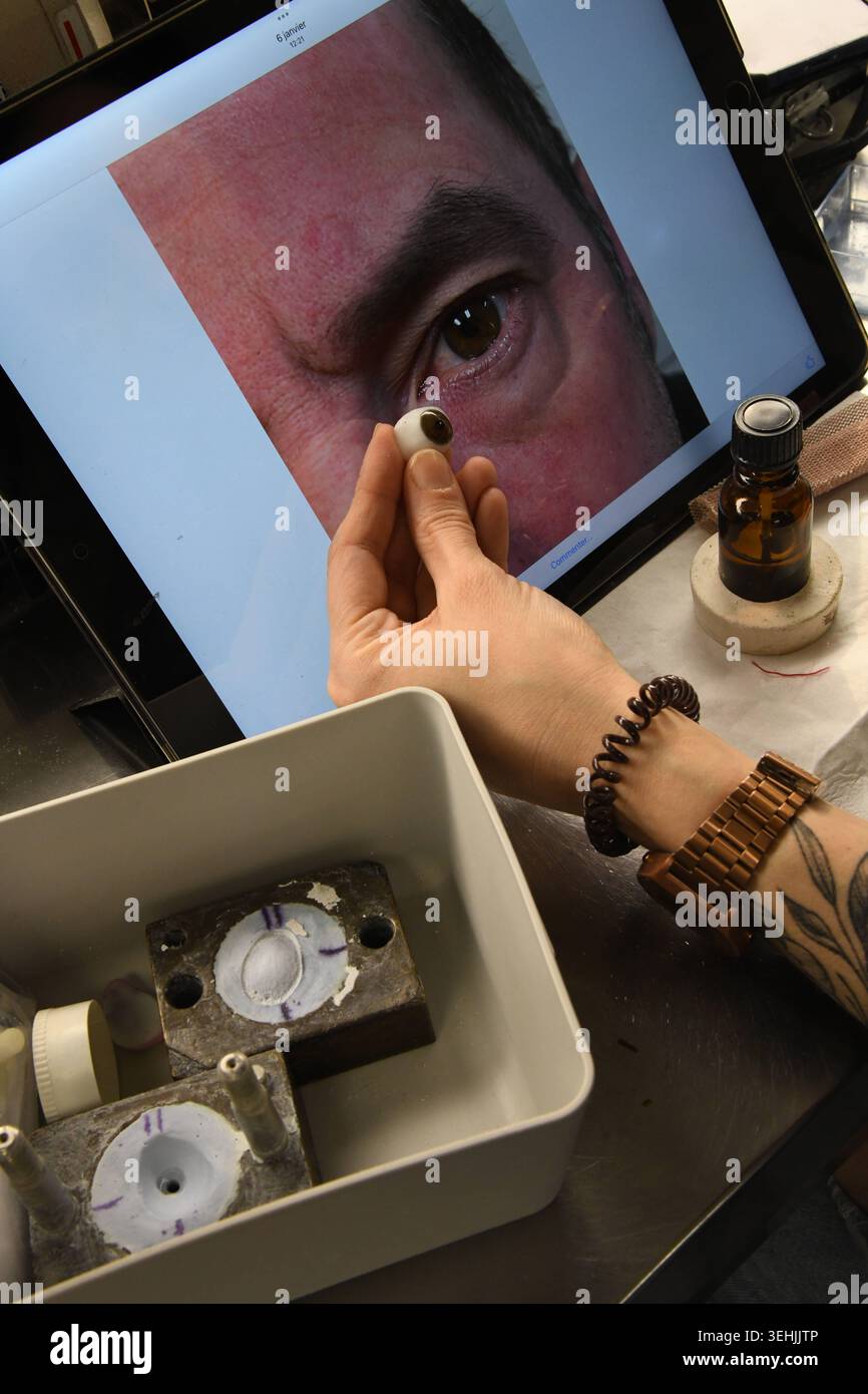 Ocularist holding an ocular prosthesis in front of a tablet displaying ...
