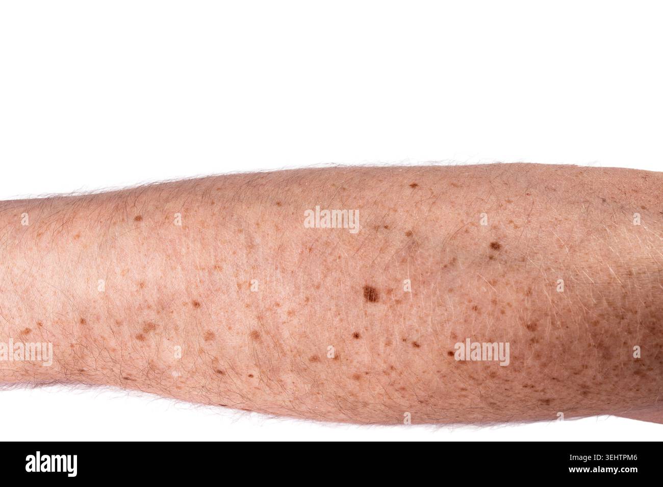Human arm with multiple moles and freckles, skin cancer screening ...
