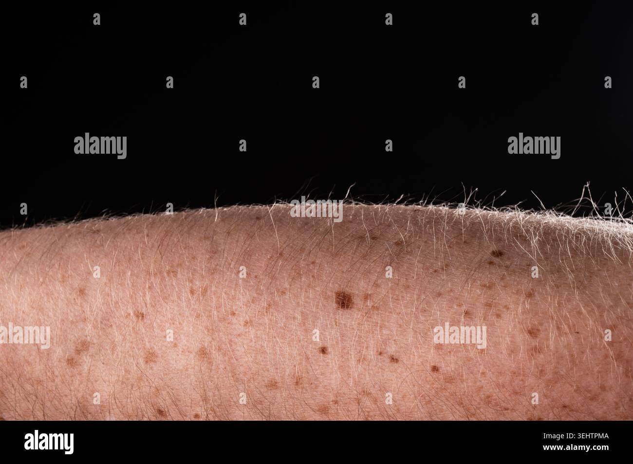 Human arm with multiple moles and freckles, skin cancer screening ...