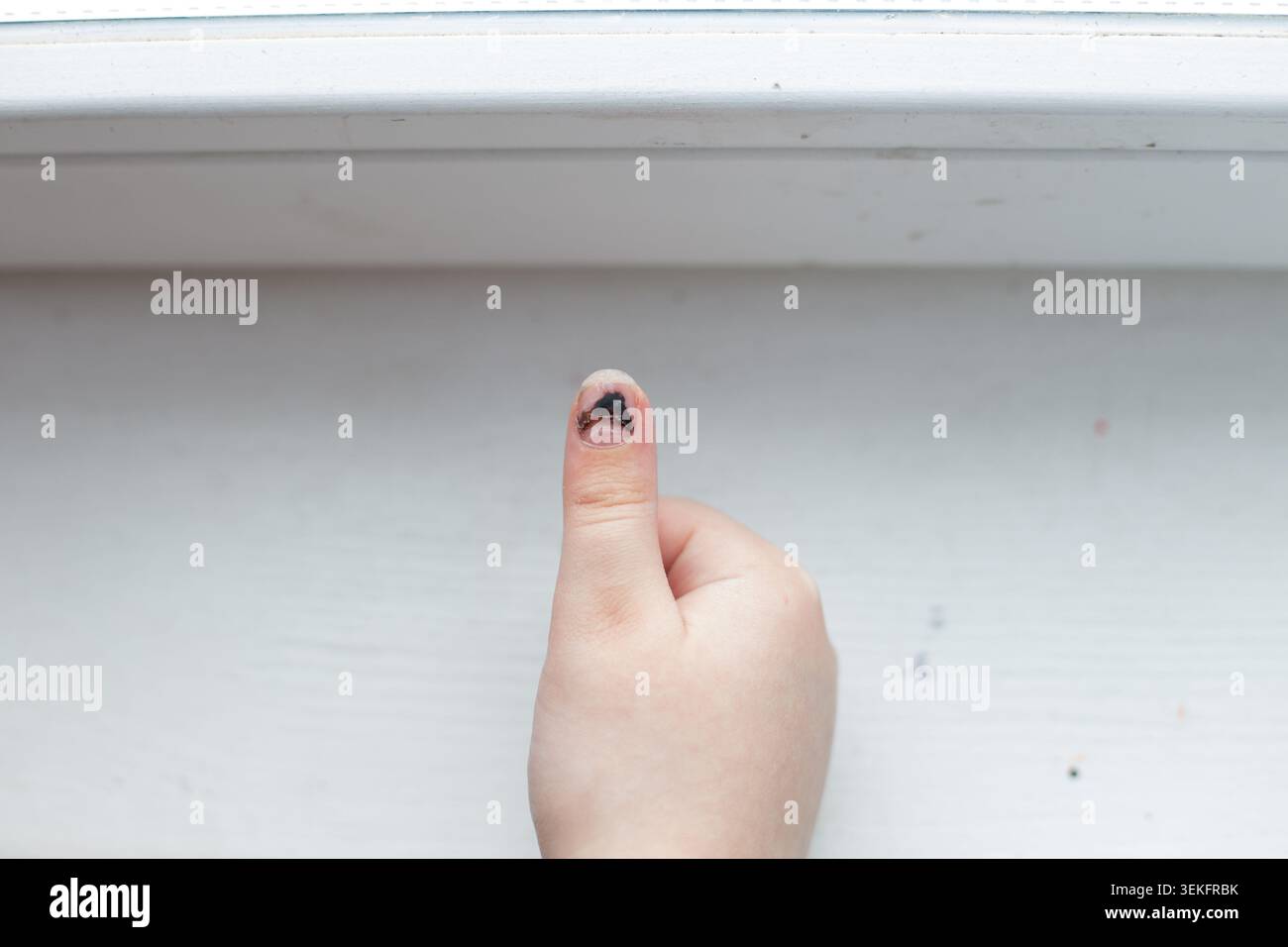 Child hand showing a bruised thumb nail, forming a subungual hematoma ...