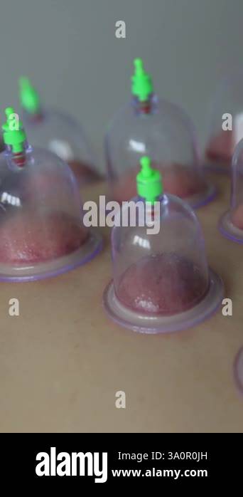 Multiple vacuum cups on human back, medical cupping therapy in room ...