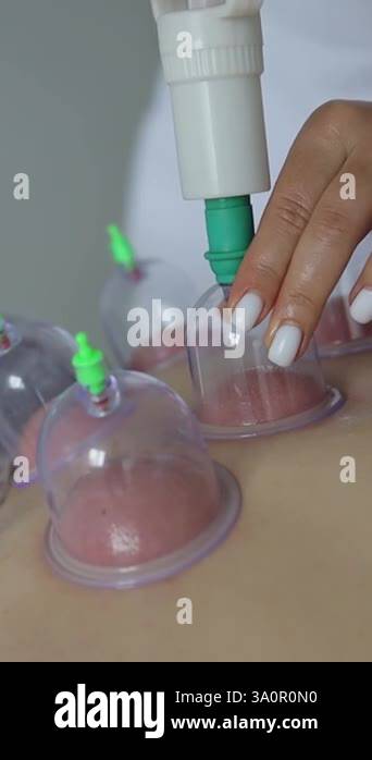 Cupping therapy relaxation relief muscle Stock Videos & Footage - HD ...