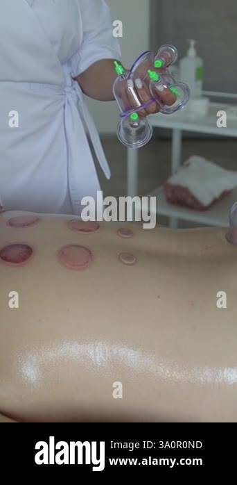 Red marks on a womans back after acupuncture and vacuum cupping therapy ...