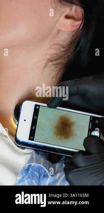 A doctor uses a digital dermatoscope to examine a mole on a patients ...