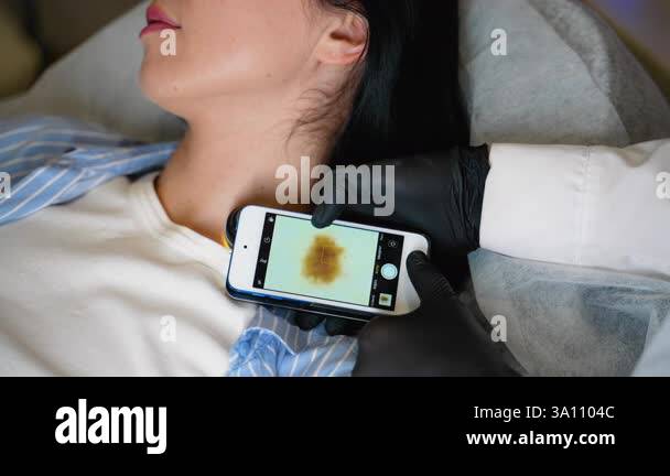 A doctor uses a digital dermatoscope to examine a mole on a patients ...