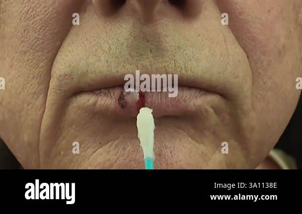 Lubrication of the cold sore with a cotton swab. Oral herpes on the lip ...