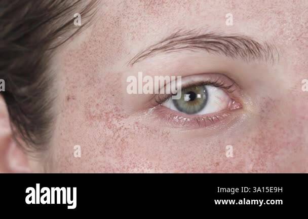 close up woman with green eyes co2 laser treatment scars face after ...