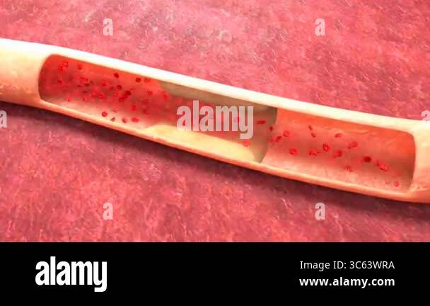 A 3D animation illustrating myocardial infarction, showing blocked ...