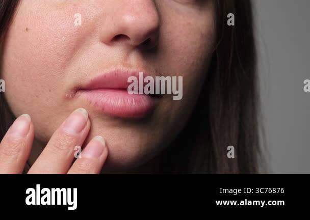 Close-up of a womans lips with a visible cold sore touching her face ...