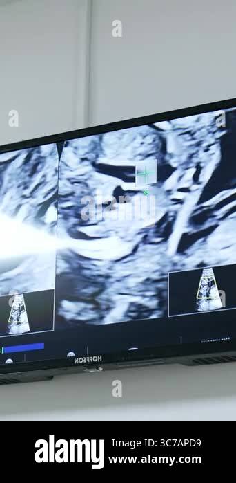Ultrasound scan screen Stock Videos & Footage - HD and 4K Video Clips ...